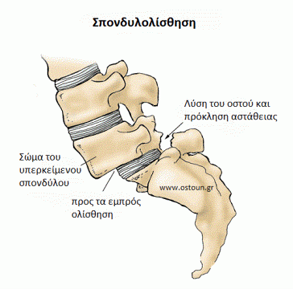 Οσφυαλγία: Πού Οφείλεται & Πώς Θεραπεύεται η Οσφυαλγια;