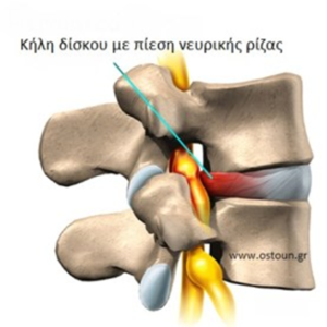 Οσφυαλγία: Πού Οφείλεται & Πώς Θεραπεύεται η Οσφυαλγια;