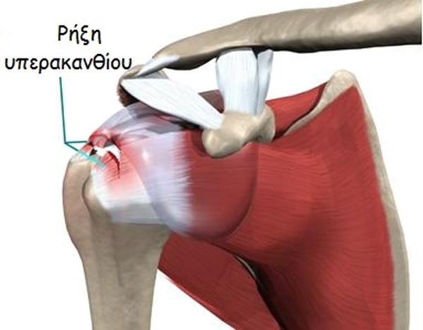 Ρήξη Yπερακανθίου: Τι Είναι & Ποια η Αντιμετώπιση της